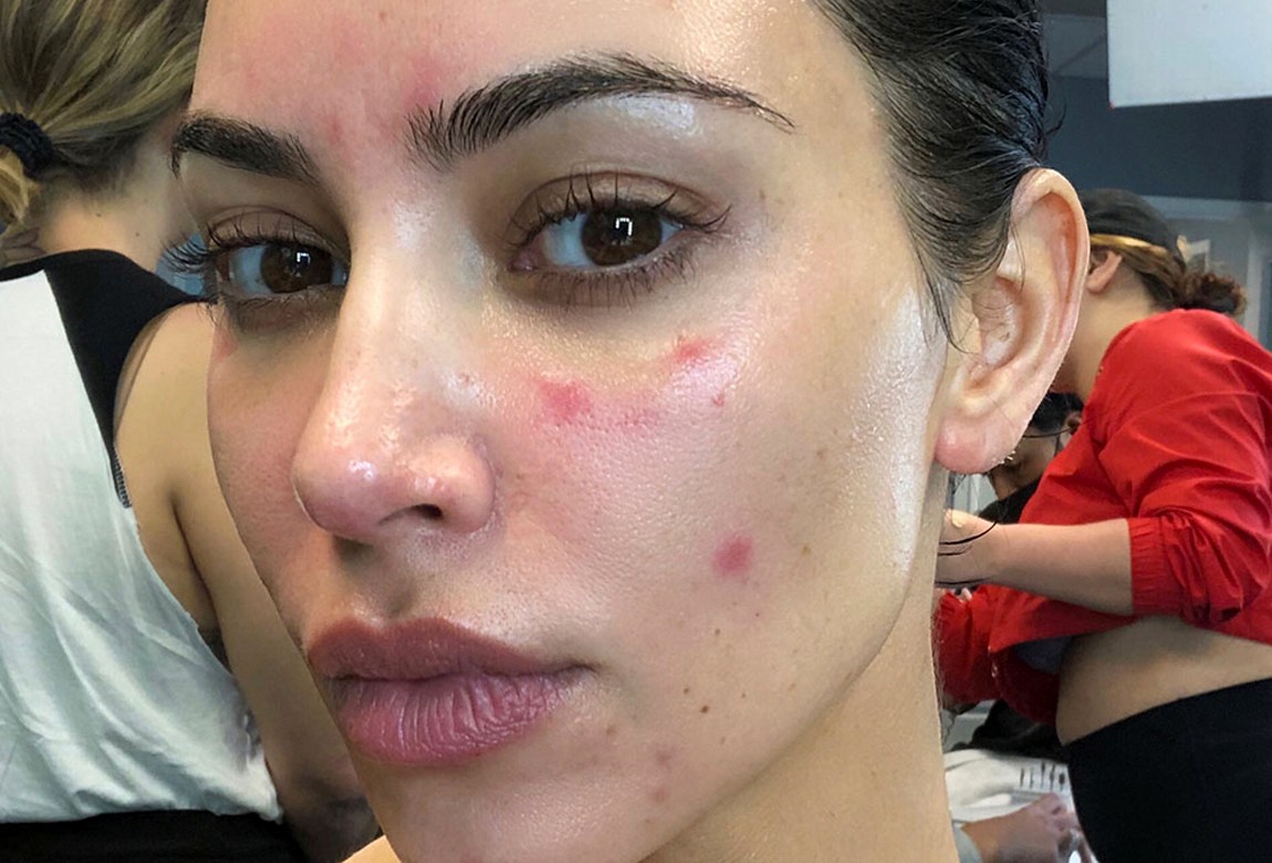 Psoriasis Cara Delevingne